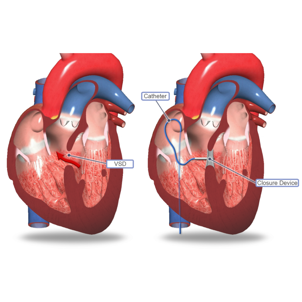 VSD Closure - Santhora Health